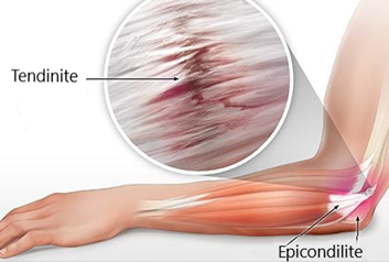 Epicondilite Lateral